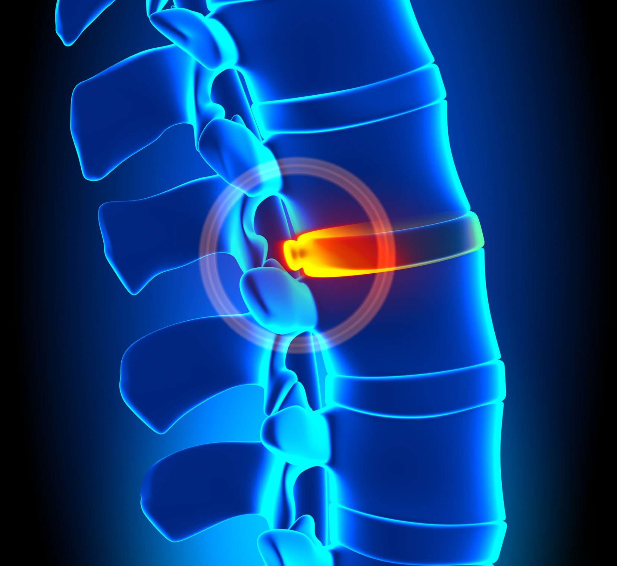 Sciatica - Citi Neuro Centre